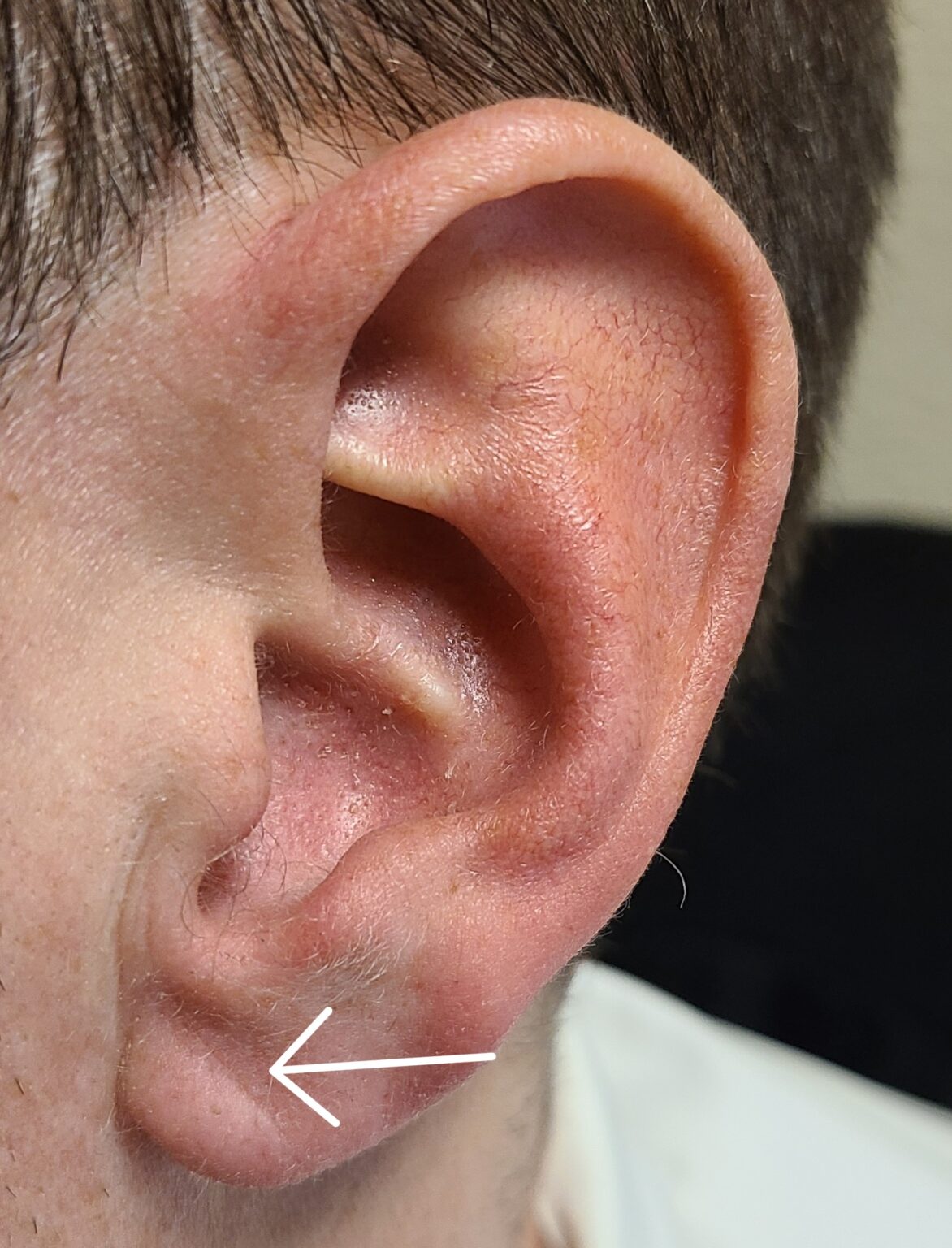 What your ears can tell you about cardiovascular disease - Hannon ...